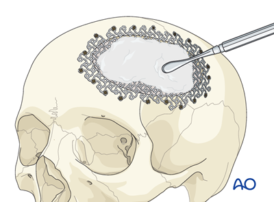 Radial forearm fasciocutaneous free flap for Cranial vault