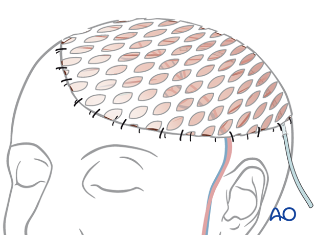 Latissimus dorsi fasciocutaneous free flap for Cranial vault
