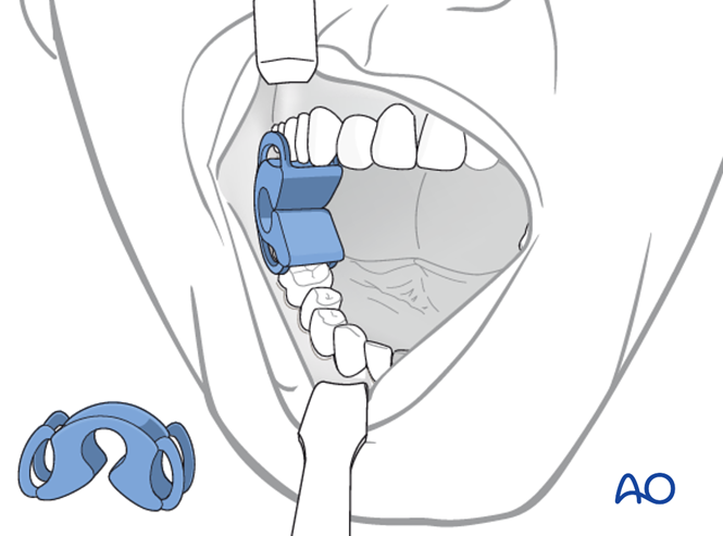 Radial forearm fasciocutaneous free flap for Marginal mandible, inner ...
