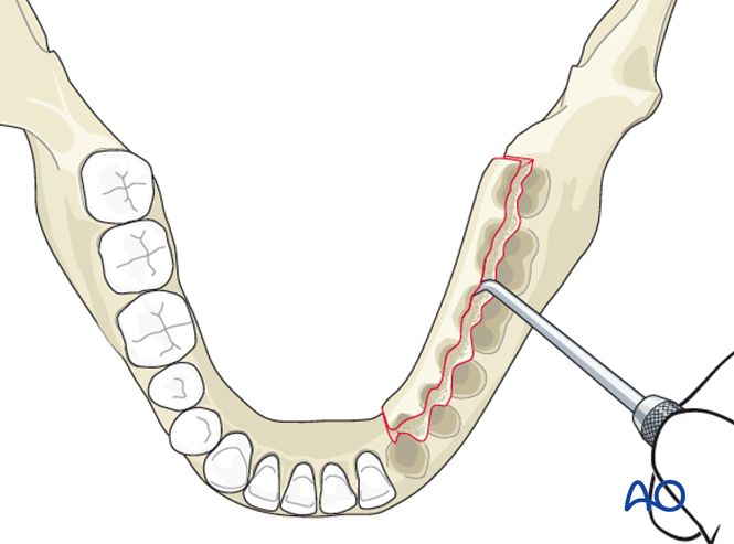 Radial forearm fasciocutaneous free flap for Marginal mandible, inner ...