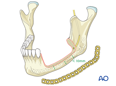 Radial forearm fasciocutaneous free flap for Marginal mandible, full ...