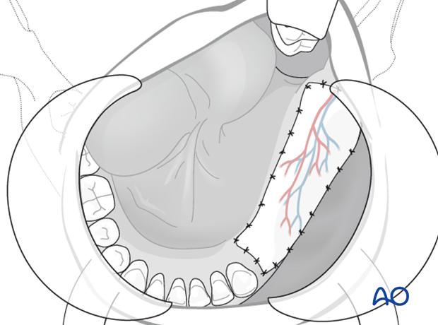 Radial forearm fasciocutaneous free flap for Marginal mandible, full ...
