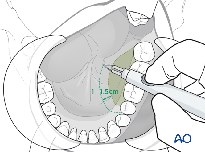 Primary closure for Lateral mandible, mucosa, with or without tongue ...