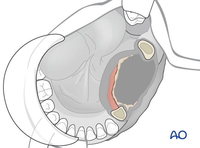 Primary closure for Lateral mandible, mucosa, with or without tongue ...