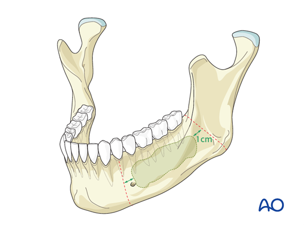 Primary closure for Lateral mandible, mucosa, with or without tongue ...