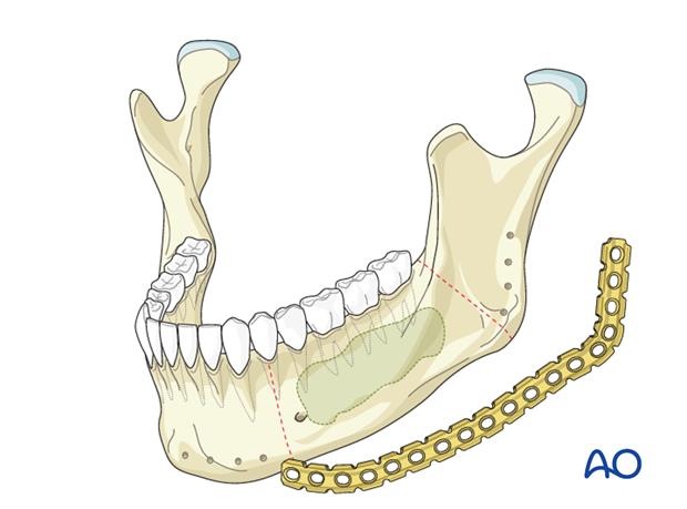 Plate and radial forearm fasciocutaneous free flap for Lateral mandible ...