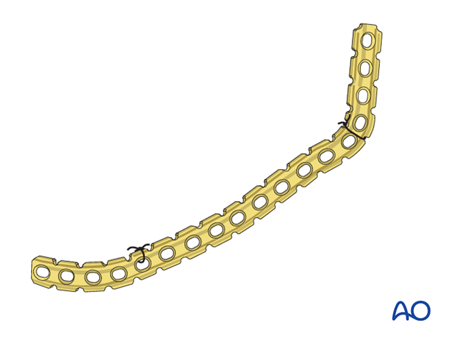 Plate and scapular osteocutaneous free flap for Lateral mandible ...