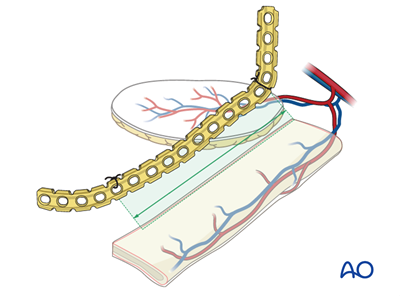 Plate and scapular osteocutaneous free flap for Lateral mandible ...