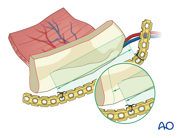Plate and iliac crest-internal oblique free flap for Lateral mandible ...