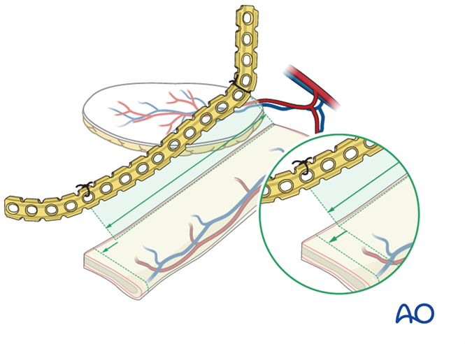 Plate and scapular osteocutaneous free flap for Lateral mandible ...