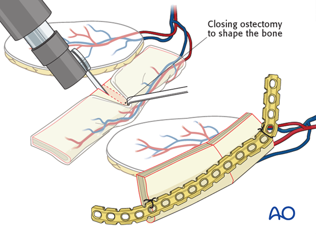 Plate and scapular osteocutaneous free flap for Lateral mandible ...