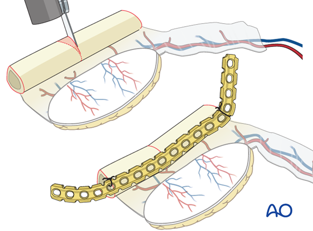 Plate and fibular osteocutaneous free flap for Lateral mandible and skin