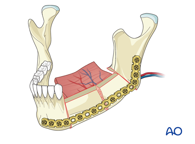 Plate and iliac crest-internal oblique free flap for Lateral mandible ...