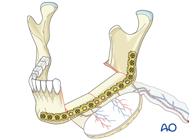 Plate and fibular osteocutaneous free flap for Lateral mandible, mucosa ...
