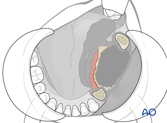 Radial forearm fasciocutaneous free flap for Lateral mandible, mucosa ...
