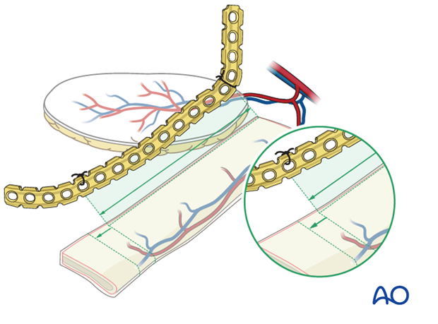 Plate and scapular osteocutaneous free flap for Lateral mandible ...