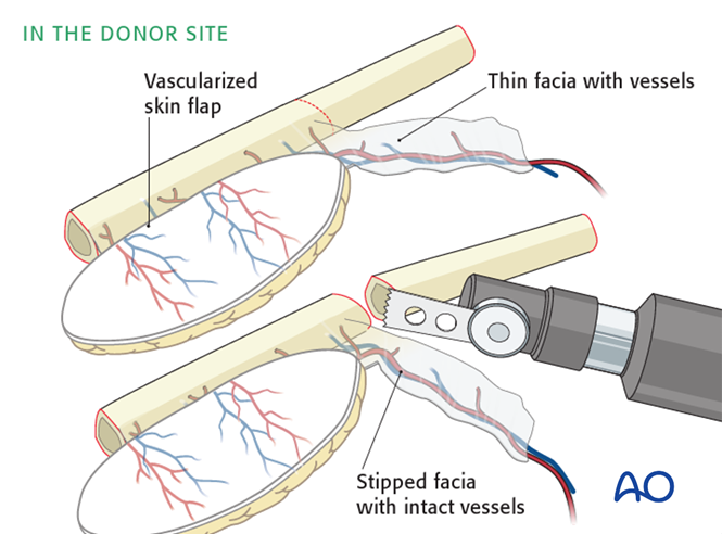 Plate and fibular osteocutaneous free flap for Symphysis, mucosa, with ...