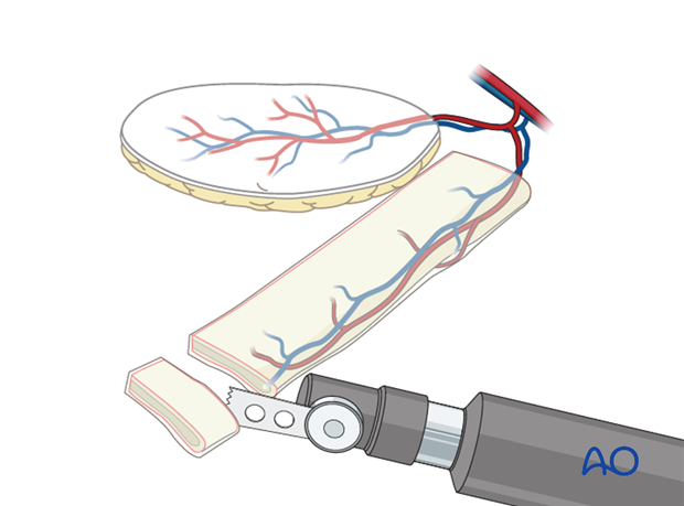 Plate and scapular osteocutaneous free flap for Lateral mandible ...