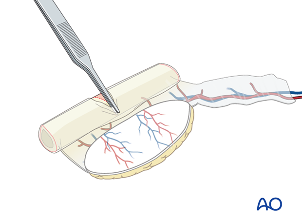 Plate and fibular osteocutaneous free flap for Symphysis, mucosa, with ...