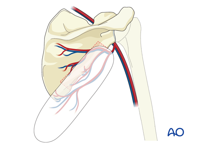 Plate and scapular osteocutaneous free flap for Lateral mandible ...