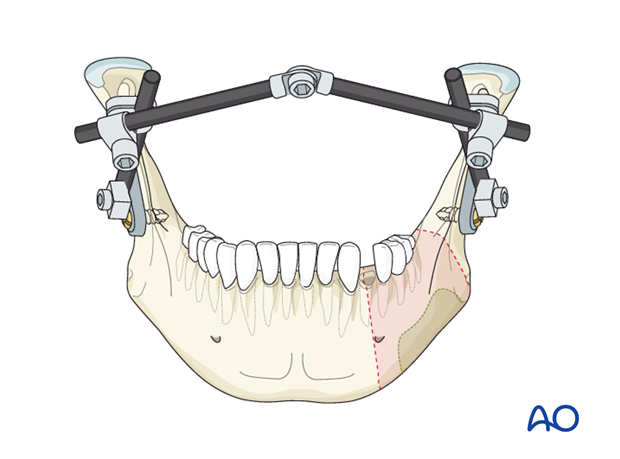 Plate and radial forearm fasciocutaneous free flap for Lateral mandible ...
