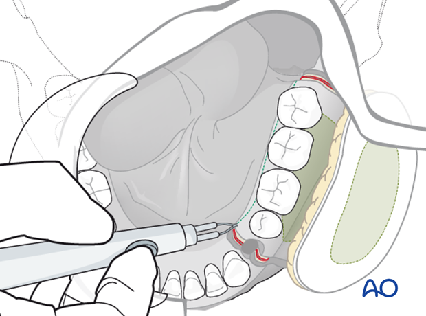 Plate and scapular osteocutaneous free flap for Lateral mandible and skin