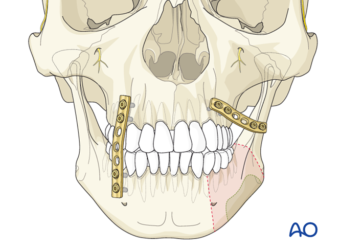 Plate and radial forearm fasciocutaneous free flap for Lateral mandible ...