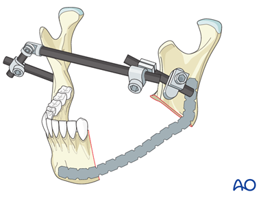 Plate and radial forearm fasciocutaneous free flap for Lateral mandible ...