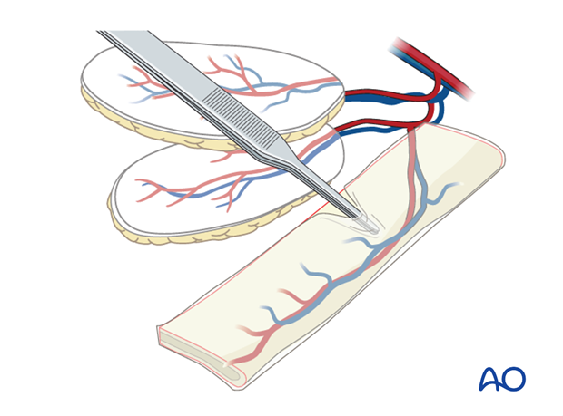 Plate and scapular osteocutaneous free flap for Symphysis, mucosa and skin