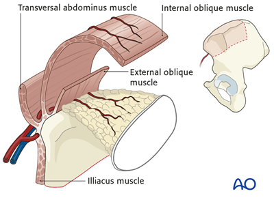 Plate and iliac crest internal oblique free flap for Lateral mandible ...