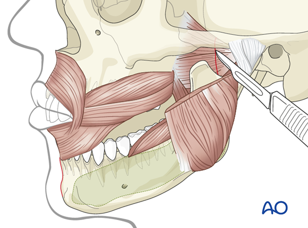 Plate and scapular osteocutaneous free flap for Symphysis, lateral ...