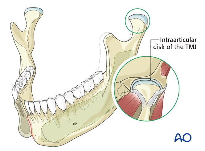 Plate and scapular osteocutaneous free flap for Symphysis, lateral ...