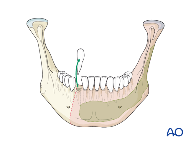 Plate and scapular osteocutaneous free flap for Symphysis, lateral ...