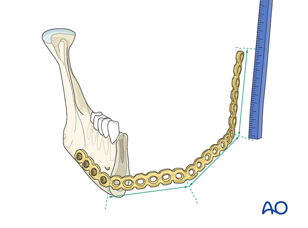 Plate and fibular osteocutaneous with radial forearm free flap for ...