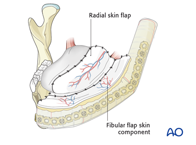 Plate and fibular osteocutaneous with radial forearm free flap for ...