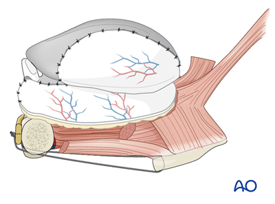 Plate and fibular osteocutaneous with radial forearm free flap for ...