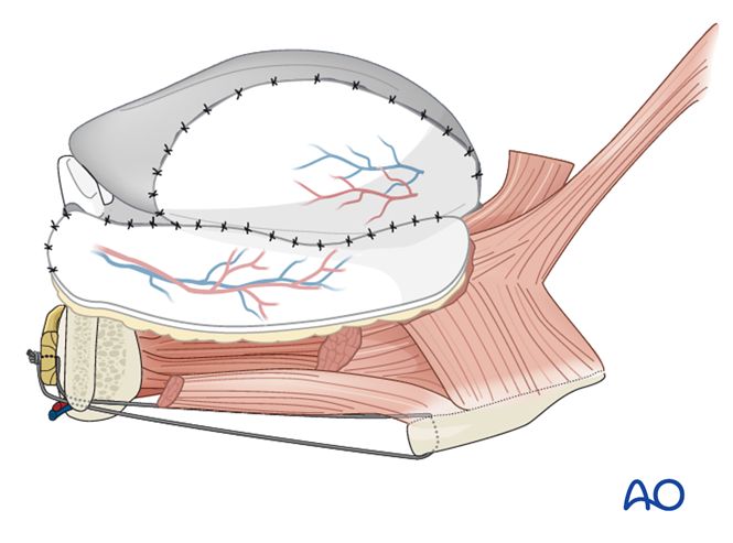 Plate and scapular osteocutaneous free flap for Symphysis, mucosa ...