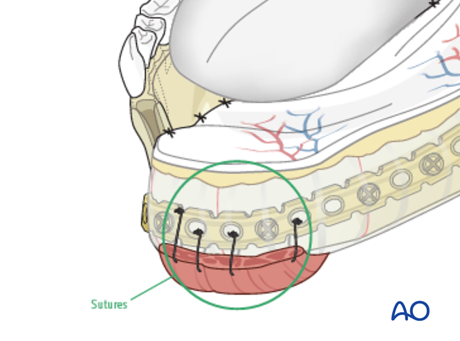 Plate and scapular osteocutaneous free flap for Symphysis, mucosa, with ...
