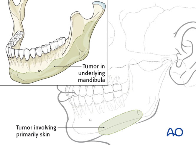 Plate and scapular osteocutaneous free flap for Symphysis, lateral ...