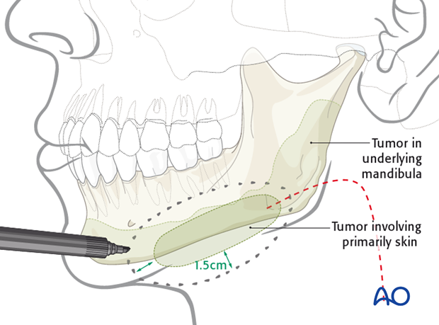 Plate and scapular osteocutaneous free flap for Symphysis, lateral ...
