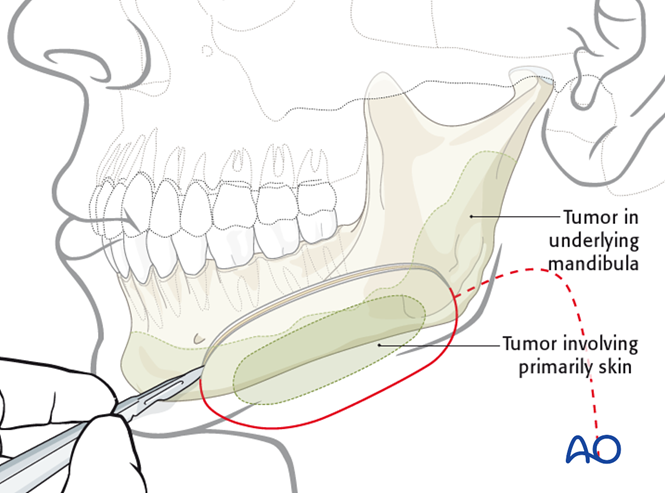Plate and scapular osteocutaneous free flap for Symphysis, lateral ...