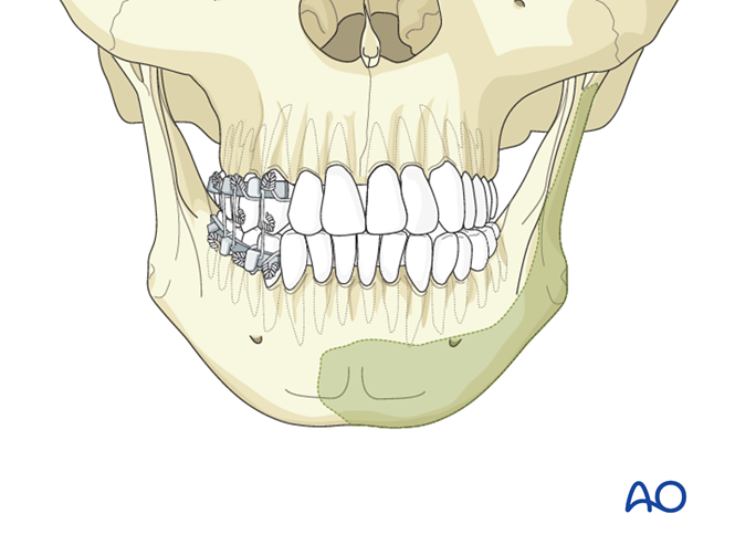 Plate and scapular osteocutaneous free flap for Symphysis, lateral ...