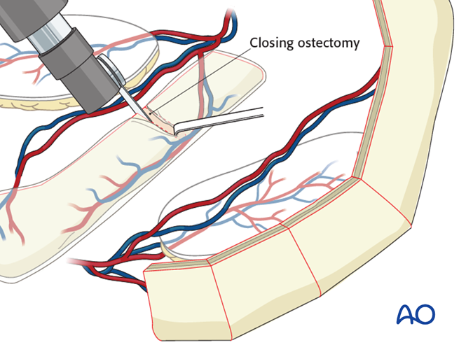 Plate and scapular osteocutaneous free flap for Symphysis, lateral ...