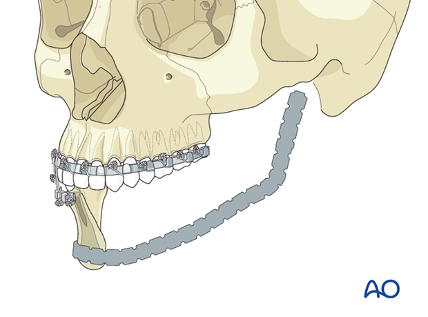 Plate and scapular osteocutaneous free flap for Symphysis, lateral ...