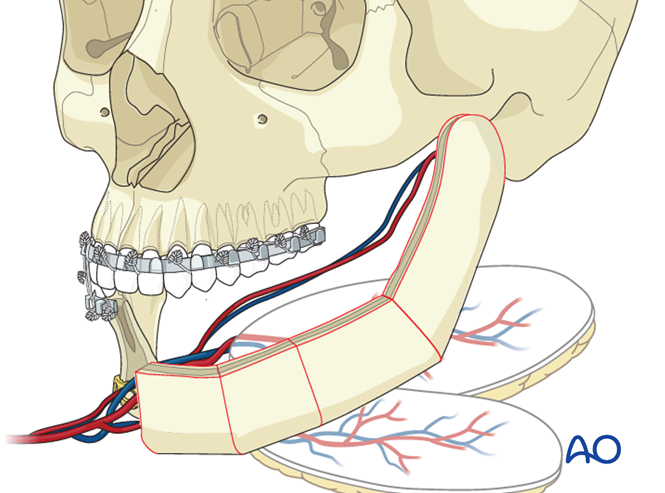 Plate and scapular osteocutaneous free flap for Symphysis, lateral ...