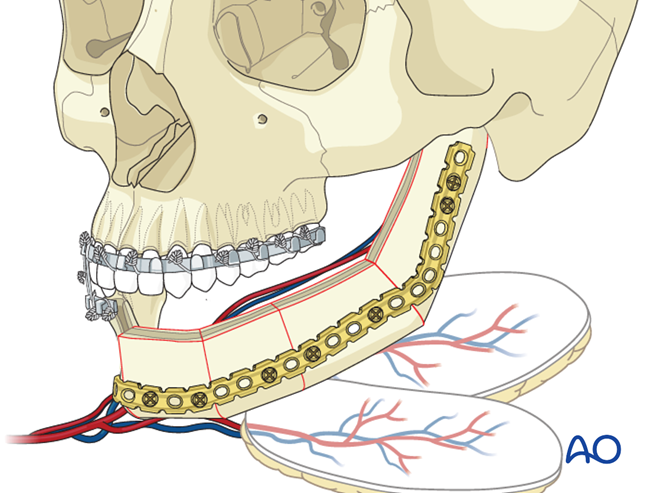 Plate and scapular osteocutaneous free flap for Symphysis, lateral ...