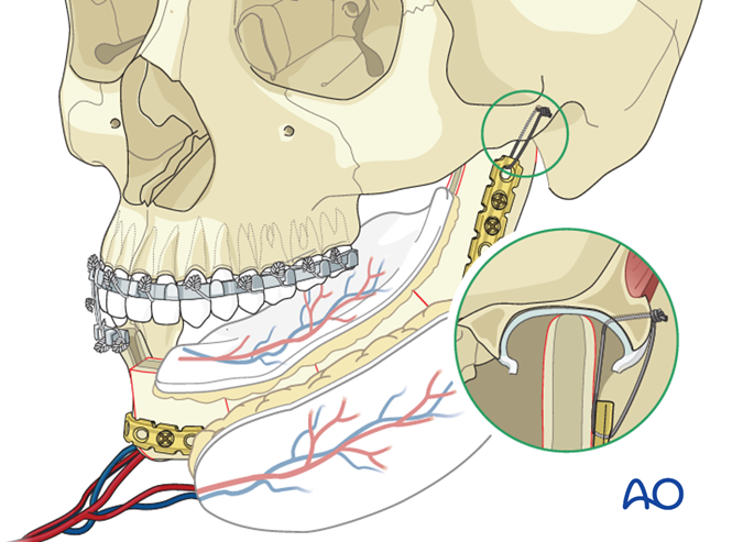 Plate and scapular osteocutaneous free flap for Symphysis, lateral ...