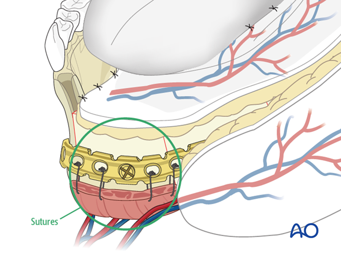 Plate and scapular osteocutaneous free flap for Symphysis, lateral ...