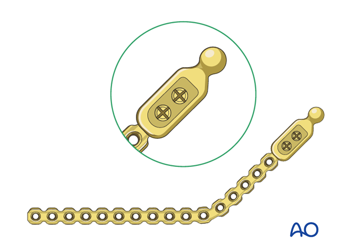 Plate and scapular osteocutaneous free flap for Lateral mandible ...