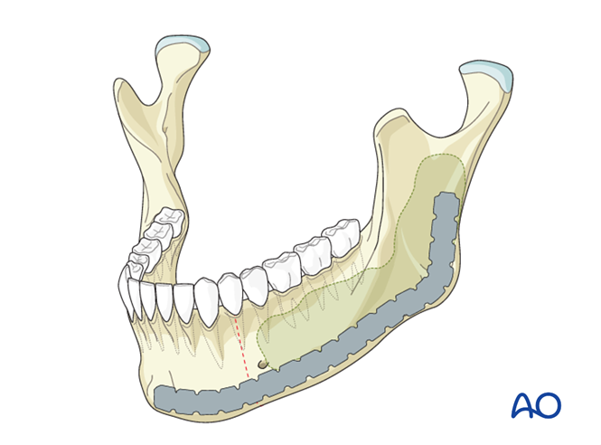 Plate and scapular osteocutaneous free flap for Lateral mandible ...